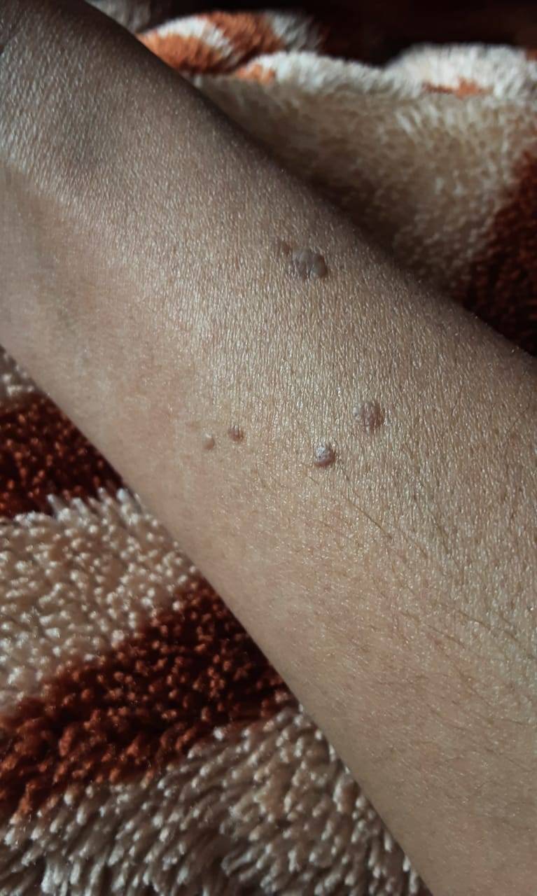 Ugly warts Cured by Classical homeopathy and medicine transmission | Case Study