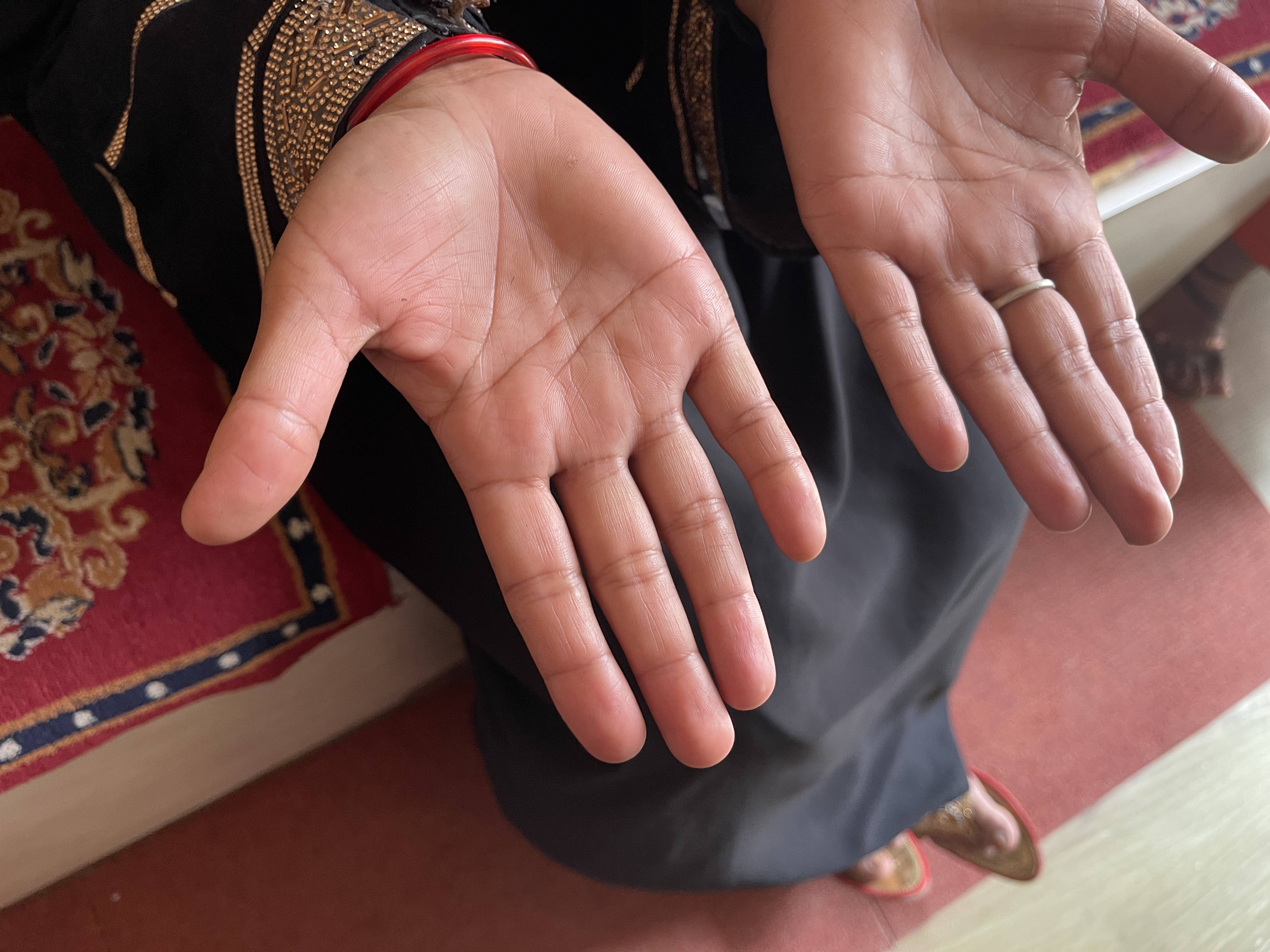 Chronic Hyper hydrosis (Sweat Problem) from last 2 - 3 years & Wart ...