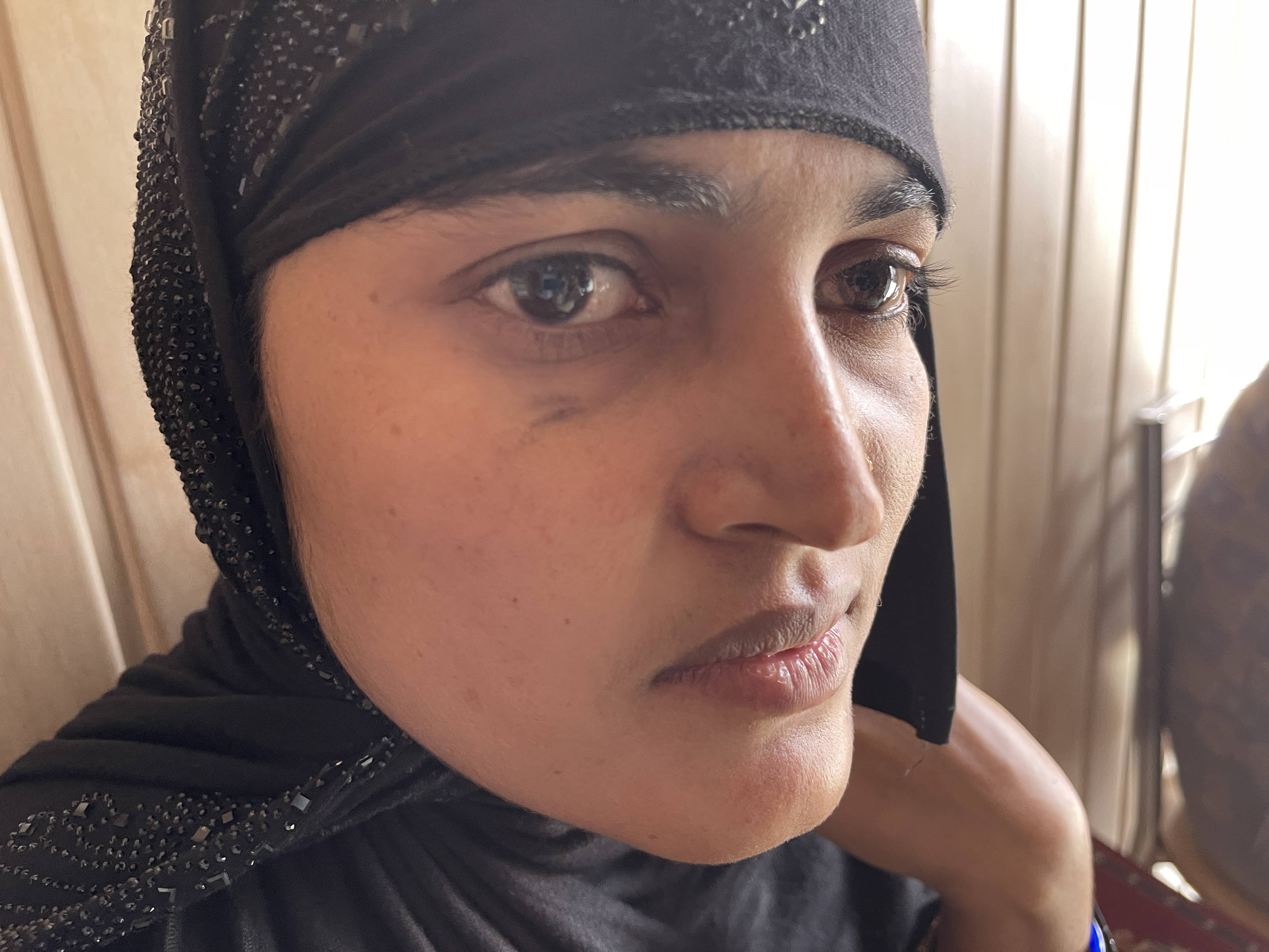 Chronic Hyper hydrosis (Sweat Problem) from last 2 - 3 years & Wart ...