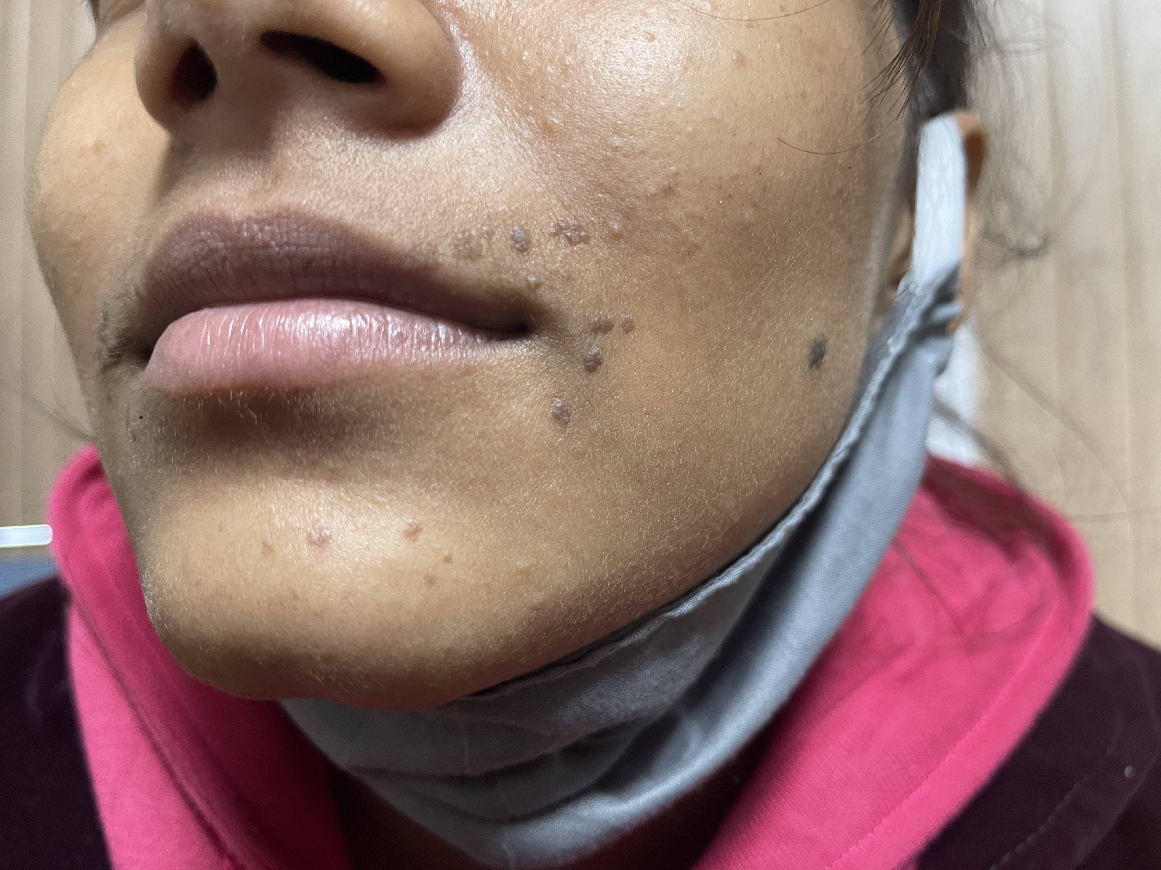 Ugly warts Cured by Classical homeopathy and medicine transmission | Case Study