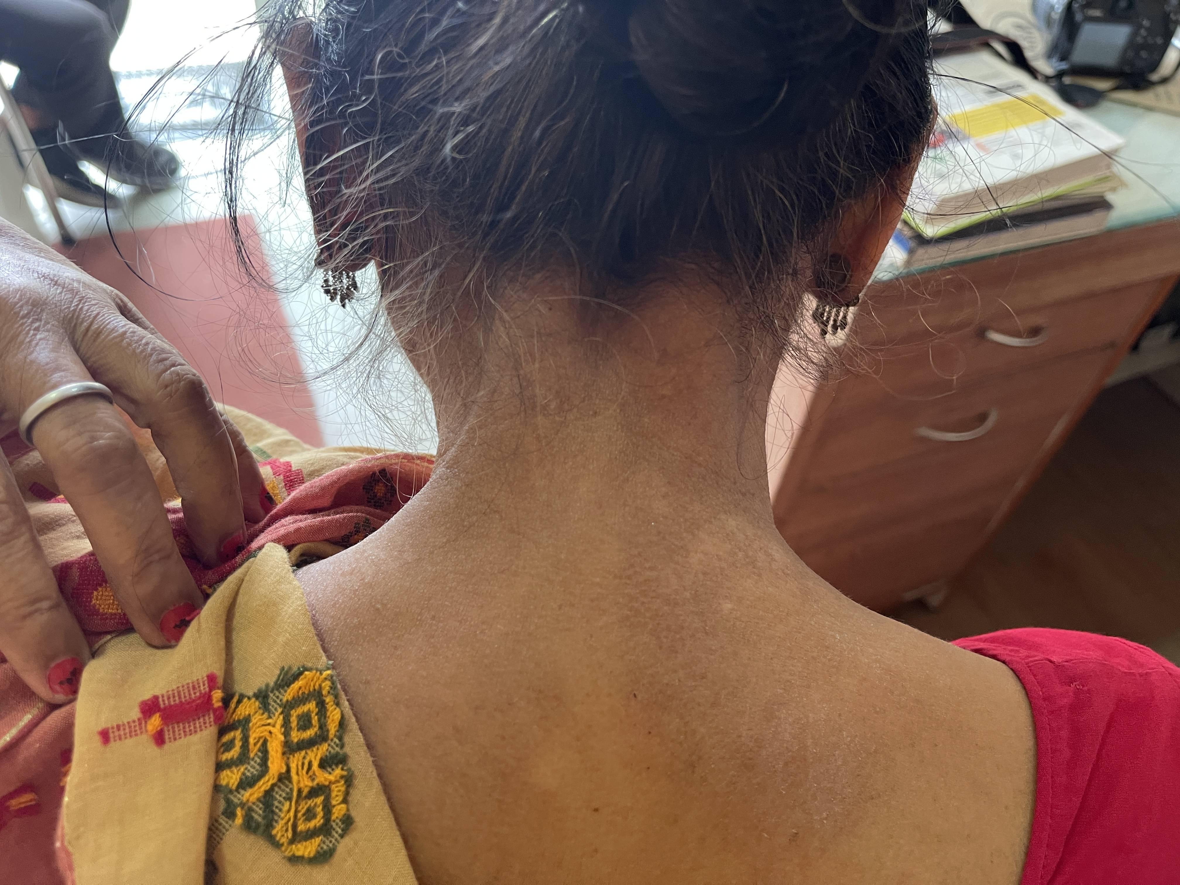 Case of Extensive Vitiligo Getting Cured with Classical homeopathy ...