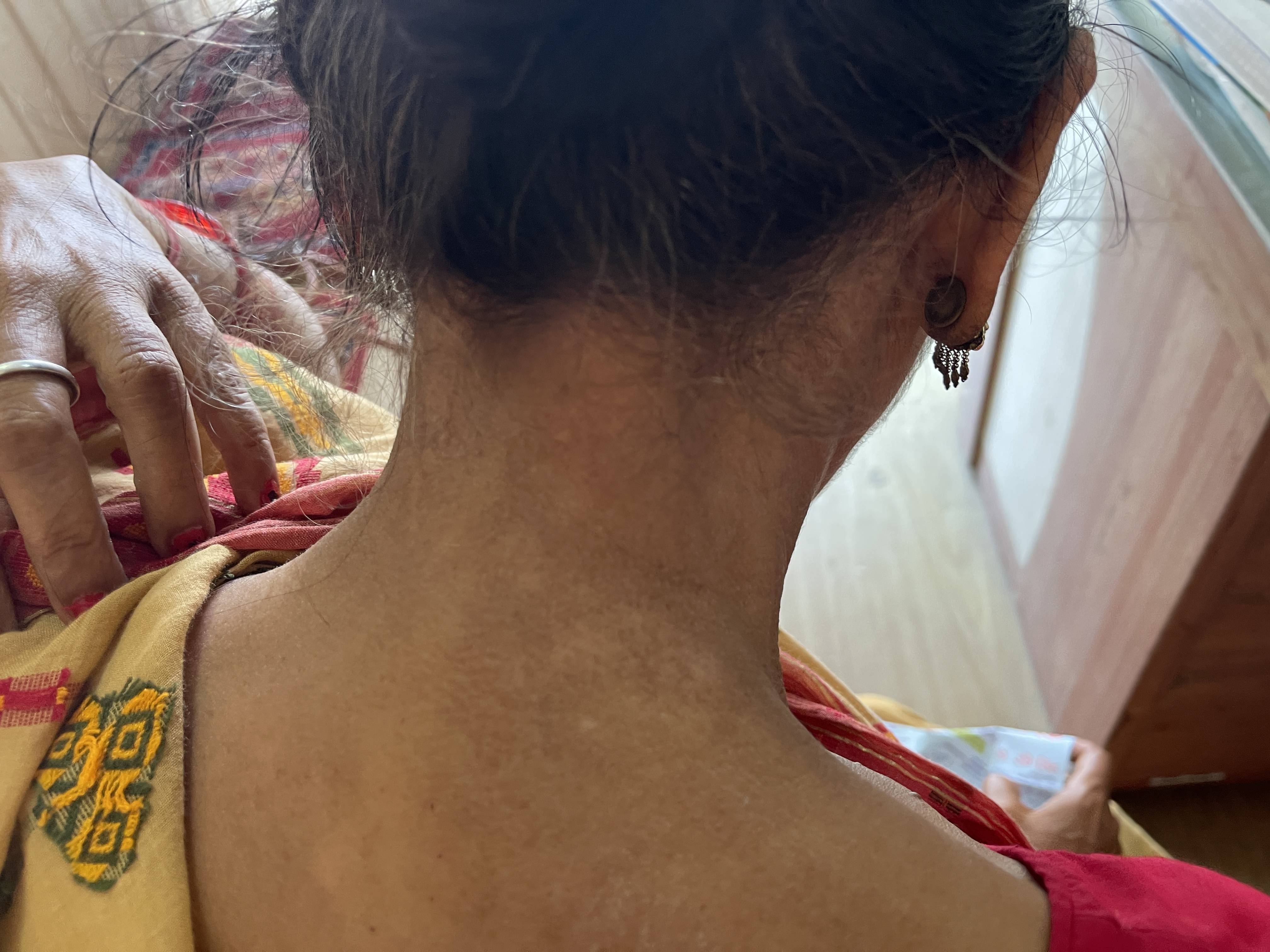 Case of Extensive Vitiligo Getting Cured with Classical homeopathy ...