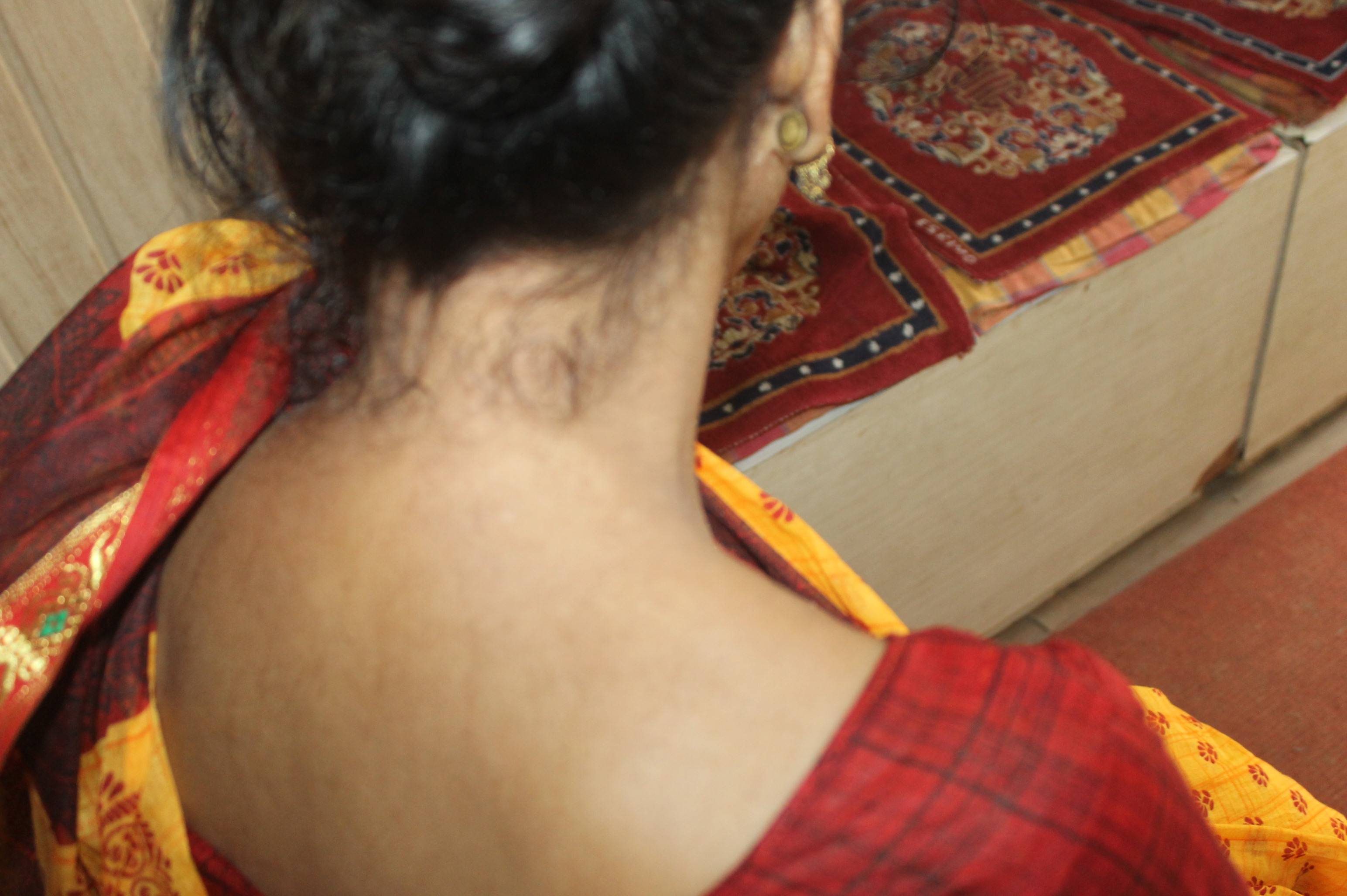 Case of Extensive Vitiligo Getting Cured with Classical homeopathy ...