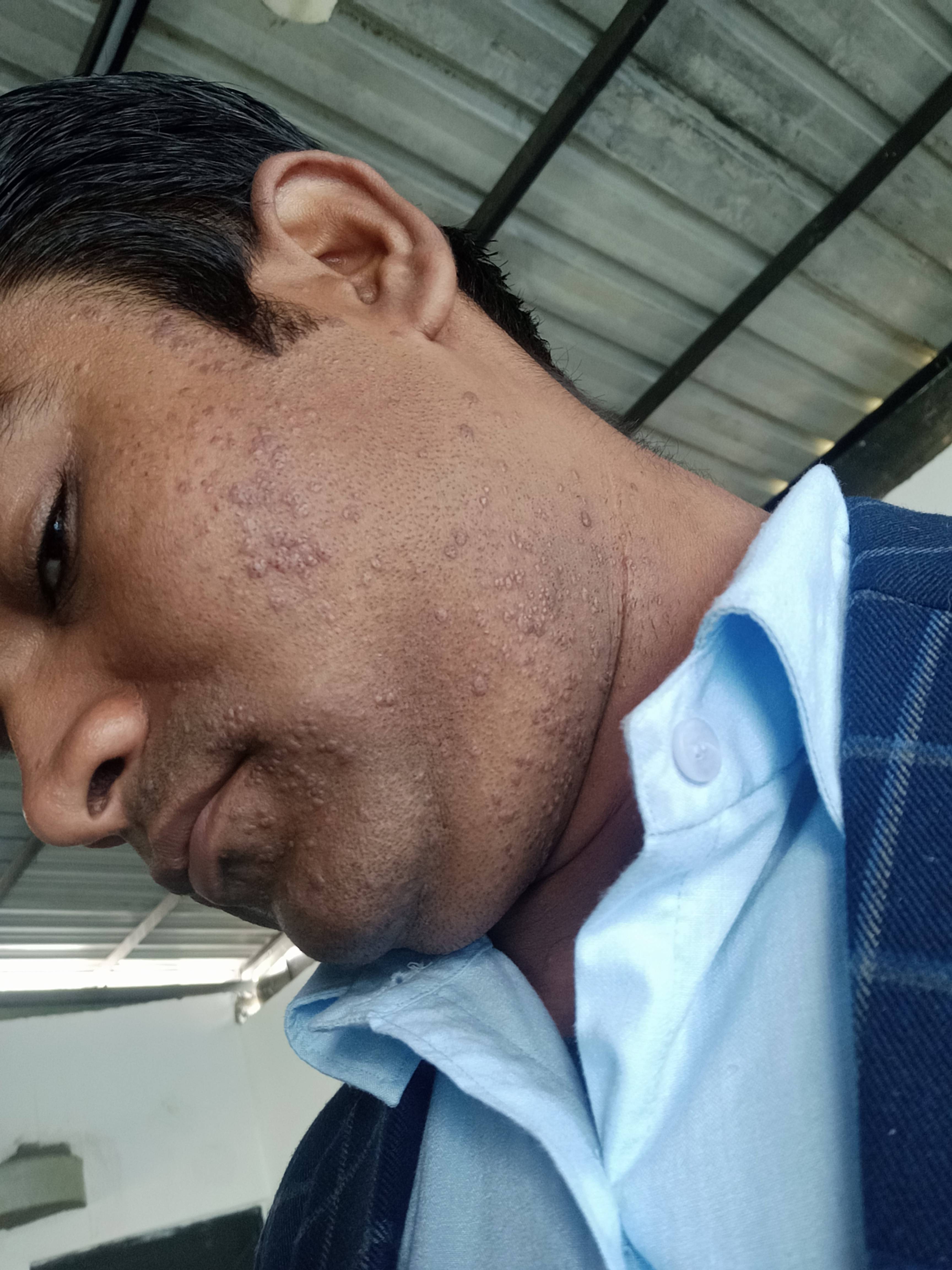 A case of Flat warts/ Verruca Plana for 4 years cured Who took a second ...