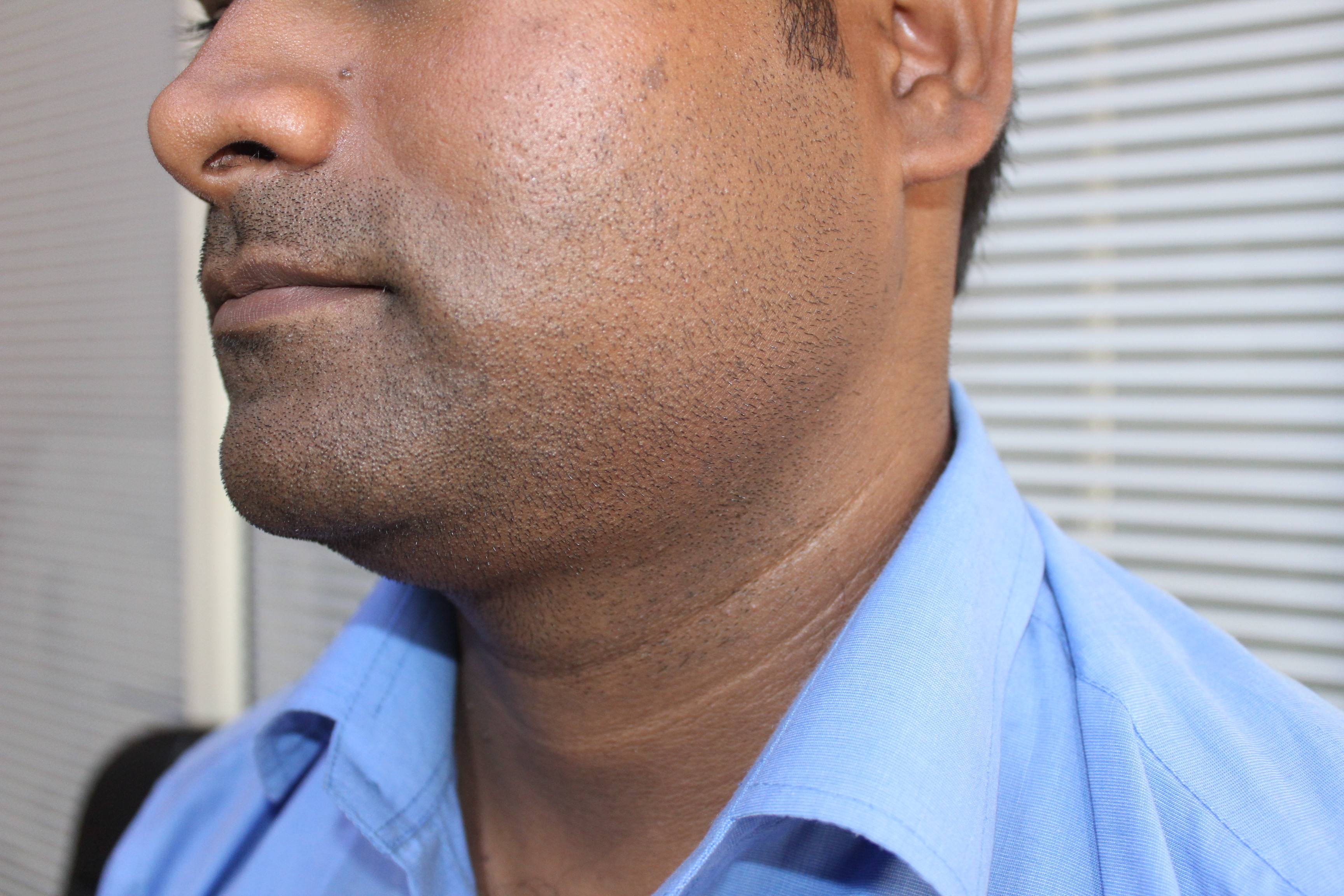 A case of Flat warts/ Verruca Plana for 4 years cured Who took a second ...